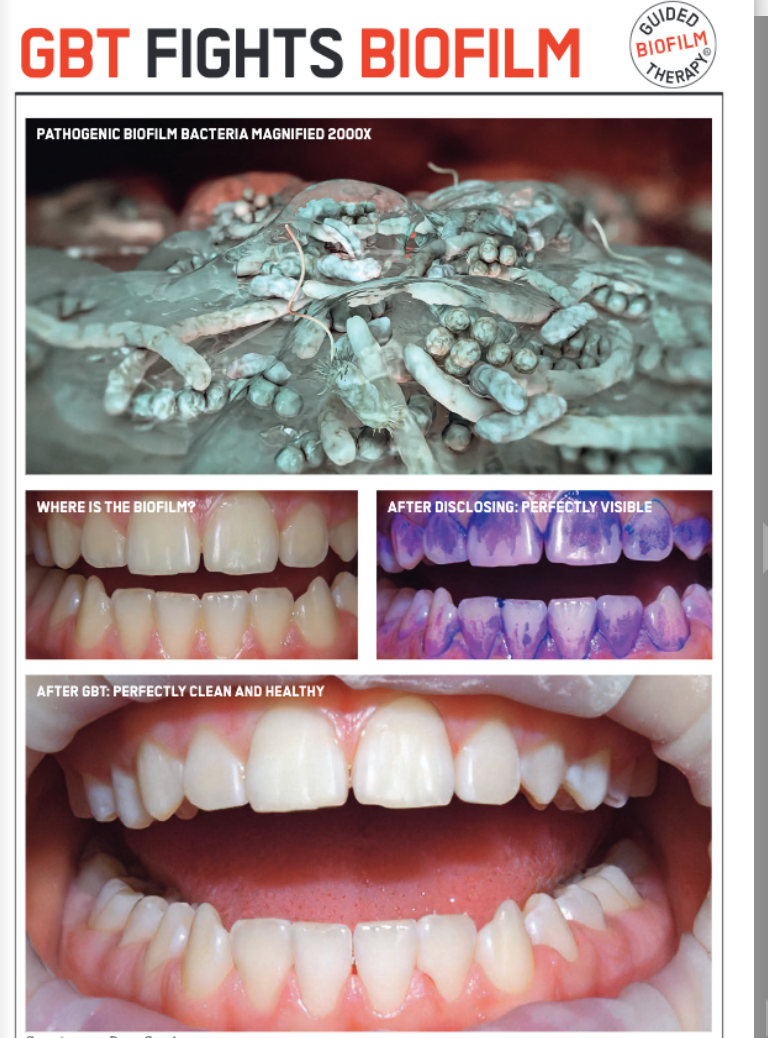 Teeth Cleaning Spa | Winterholler Dental Implants & Cosmetic Dentistry