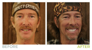 before-after-tim | Winterholler Dental Implants & Cosmetic Dentistry